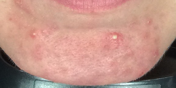 Hoeveel behandelingen bij acne - Acne Kliniek Drenthe